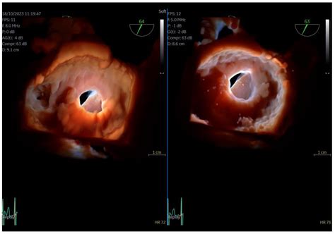 Initial Experience With The 4d Mini Tee Probe In The Adult Population
