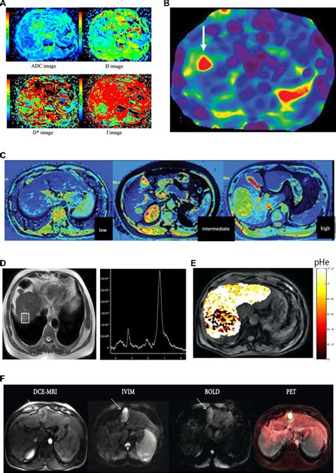 Frontiers | Magnetic resonance imaging for characterization of hepatocellular carcinoma metabolism