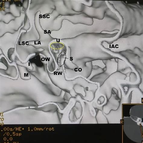 A Normal Case In A 48 Year Old Female From The Superior View Of The