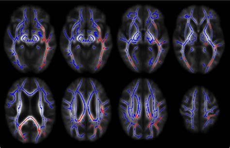 Voxelwise Group Differences In The Uncinate Fasciculus Inferior