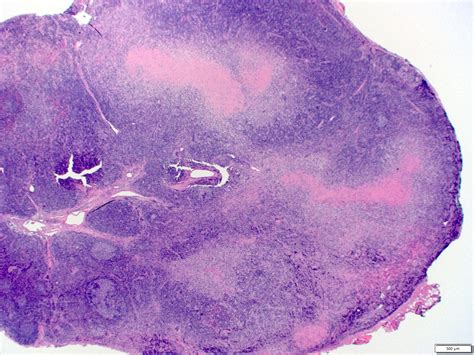 Pathology Outlines Kikuchi Disease