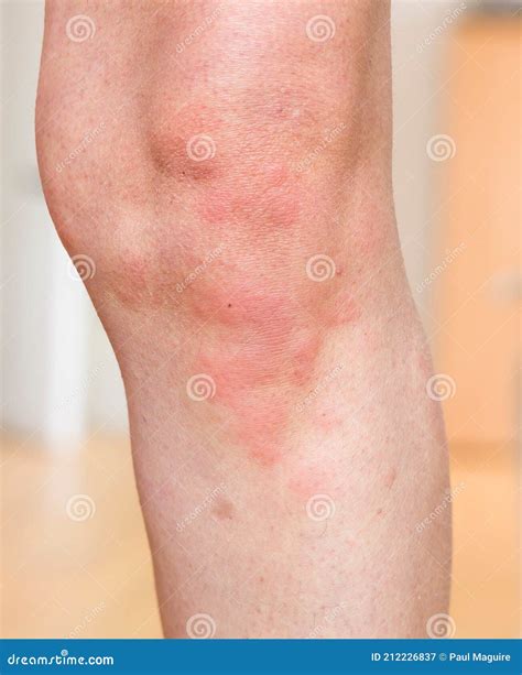 Hives Rash Urticaria Skin Condition Skin Allergy On Body Uk Stock