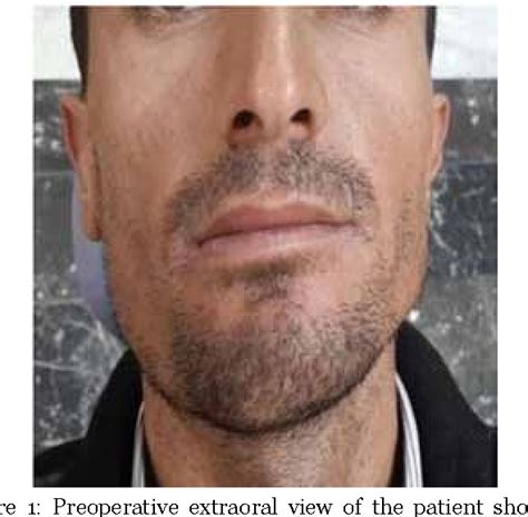 Figure 1 From A Case Report Of Osteochondroma Of The Mandibular Condyle Semantic Scholar