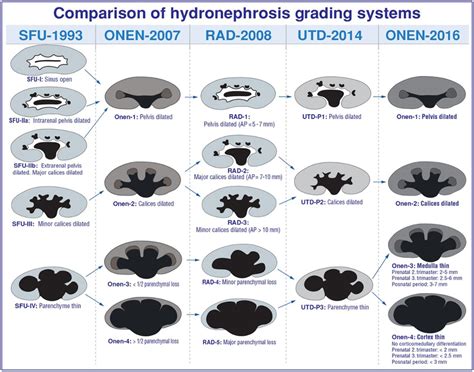 Comparison Of Hydronephrosis Garding System Download Scientific Diagram
