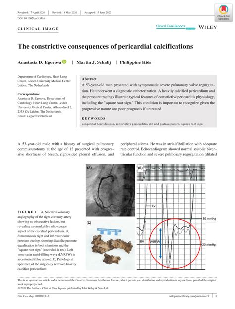 Pdf The Constrictive Consequences Of Pericardial Calcifications