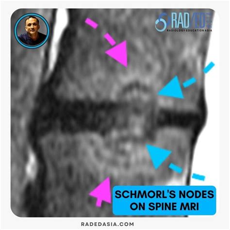 Schmorls Node On Spine Mri Acute And Chronic Schmorls Nodes Mri
