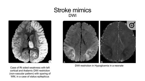 Imaging In Acute Ischemic Stroke Casespptx