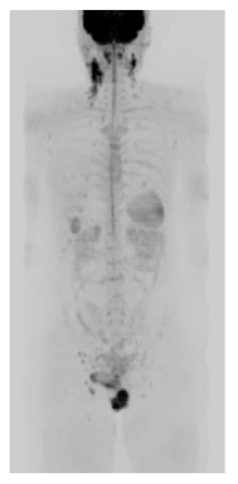 Secondary Syphilis With Tonsillar And Cervical Lymphadenopathy And A