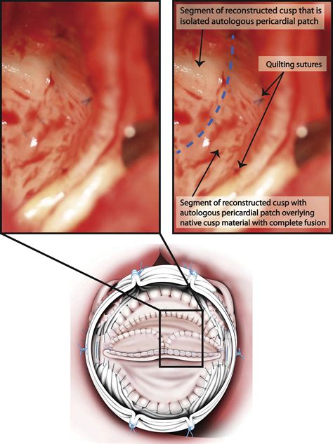 Structural Isomerism Of The Aortic Valve Bicuspidization Redux The