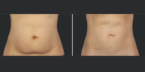 Coolsculpting Elite Vs Coolsculpting Whats The Difference Skinic