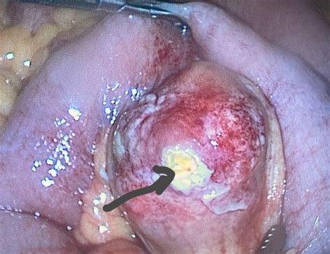 Laparoscopic Intestinal Resection For Jejunal Diverticulum