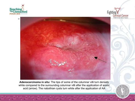 colposcopy ppt medical health