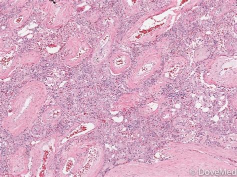 Angiomyolipoma Of Testis