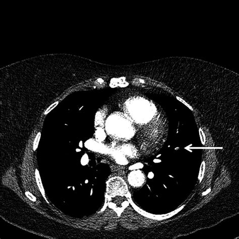 Lower Prevalence Of Subsegmental Pulmonary Embolism After Application