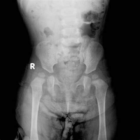 Standard Coronal Ultrasound Section Through The Acetabulum Of A Normal