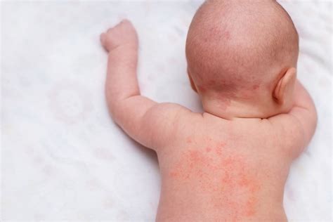 Urticaria En Bebés Causas Síntomas Y Tratamiento Completo