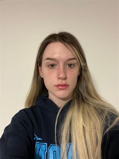 Fat Transfer Or Cheek Implants R Plasticsurgery