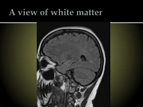 Devics Disease Devics Disease Types Symptoms Causes And Diagnosis