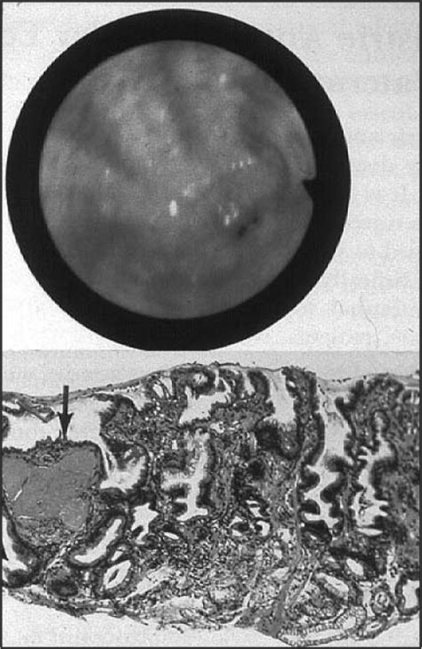 Gastric Antral Vascular Ectasia Watermelon Stomach—an Enigmatic And