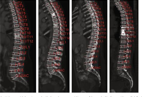 Figure 5 From Spine Detection In Ct And Mr Using Iterated Marginal