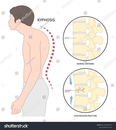 Back Neck Pain Hunched Bone Posture Stock Vector Royalty Free