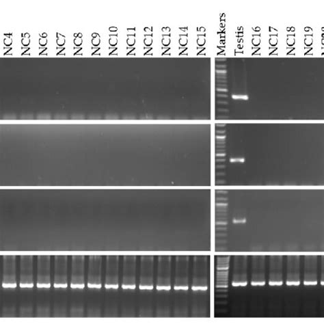 Detection Of Ssx Gene Transcripts In The Nc Tissue Samples From Male