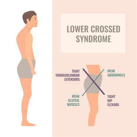 What Is Lower Cross Syndrome — Morningside Acupuncture Nyc