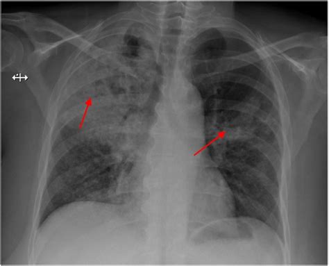 Primary Care Cxr Cxr From Initial Immediate Care Visit One Month Prior