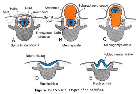 Human Anatomy Spinal Cord Spina Bifida