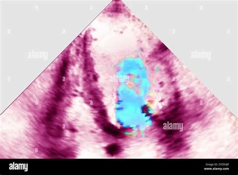 Ischemic Mitral Insufficiency Mi Pathology Of The Left Ventricle Mitral Ring And
