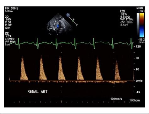 This Image Demonstrates Staccato Flow In The Renal Artery With Absent Download Scientific This Image Demonstrates Staccato Flow In The Renal Artery With Absent Download Scientific