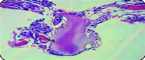 Bony Trabeculae With Presence Of Actinomyces Spp Colony Hand 400x
