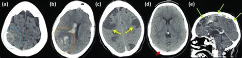 Non Contrast Computerised Tomography Ct Scans Of Brain Demonstrating