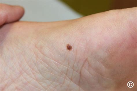 Early Acral Lentiginous Melanoma Skin Cancer Symptoms Causes And