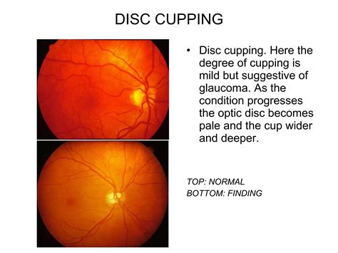 Funduscopy Ppt