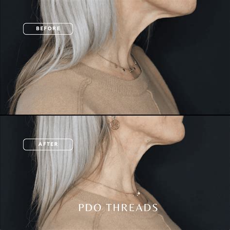 Pdo Threads Forever Clinic Cheltenham Aesthetics