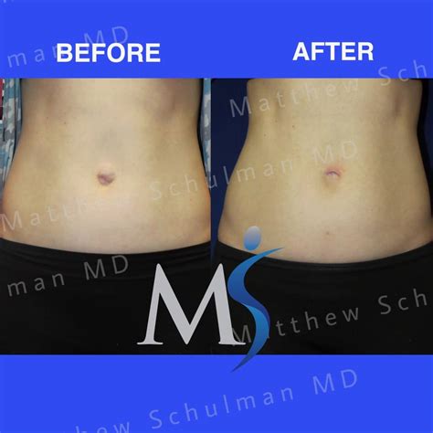 Belly Button Surgery Patient 5 Matthew Schulman M D
