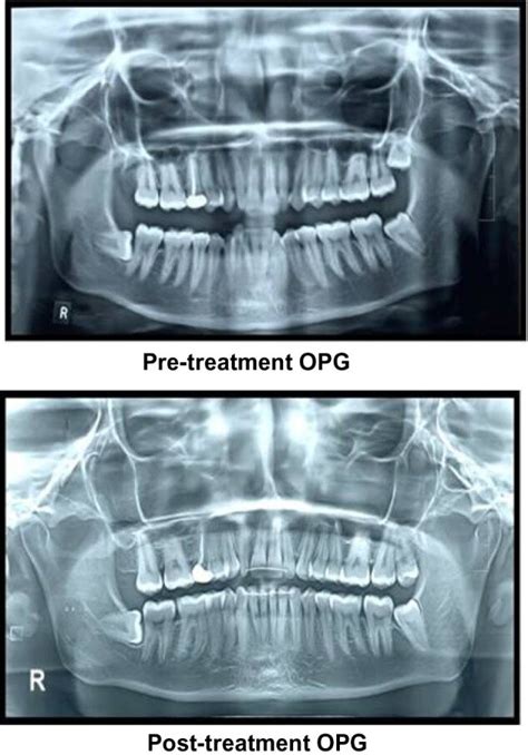 Orthopantomograph Opg