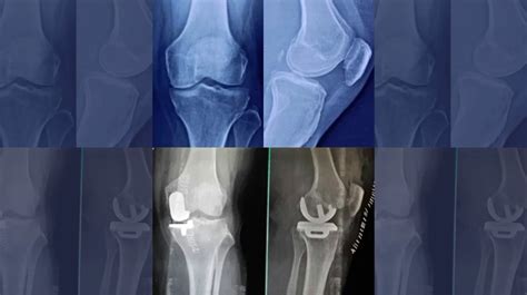 Partial Knee Replacement Surgery Is More Popular In Mumbai