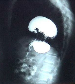 Lateral View Of Organoaxial Gastric Volvulus Download Scientific Diagram
