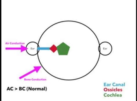 Weber Vs Rinne Test What Is The Difference Between Weber And Rinne Test Onlinelearningking