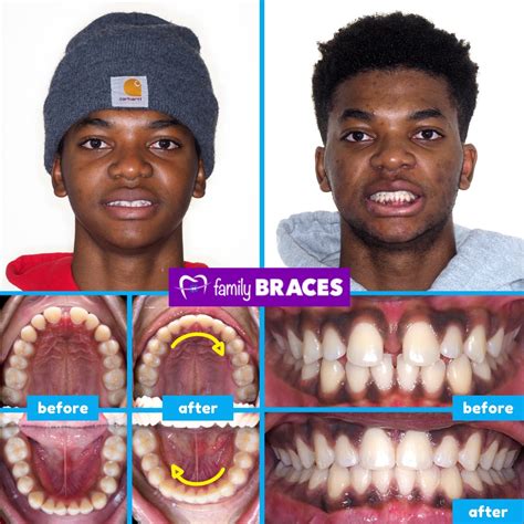 Invisalign Before And After Gap