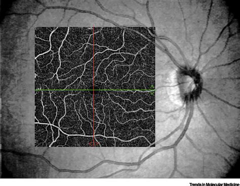 Optical Coherence Tomography Vs Fluorescein Angiography At Colin Fleming Blog