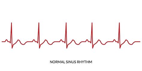 Ecg Heartbeat Line Electrocardiogram Vector Illustration Normal Sinus