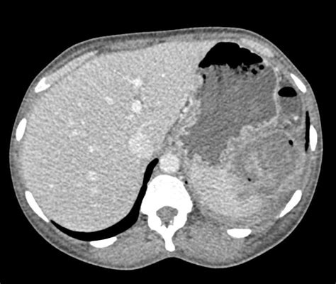 Splenic Abscess Spleen Case Studies Ctisus Ct Scanning