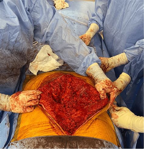 Treating Heterotopic Ossification Ho The Formation Of Ectopic Bone In Soft Tissue A