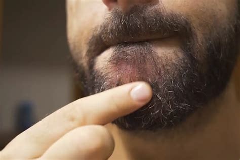 Foliculite Viral Foliculite Capilar Saiba O Que Causa E Como Curar