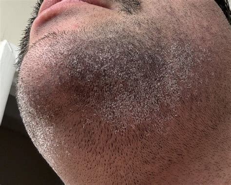 Flaky And Sore Beard What Is This Rdermatologyquestions