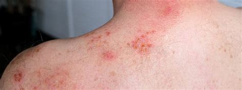 Skin Lesion Symptom In Shingles Or Herpes Zoster In Person Viral