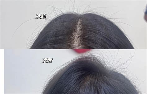 颅顶增高烫发必看！